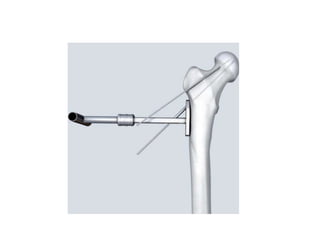 Dynamic hip screw with Trochanteric Stabilization plate Case ...