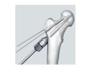 Dynamic hip screw with Trochanteric Stabilization plate Case ...