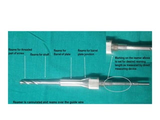 Dynamic hip screw with Trochanteric Stabilization plate Case ...