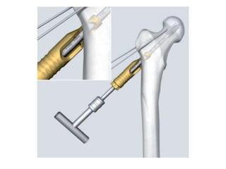 Dynamic hip screw with Trochanteric Stabilization plate Case ...