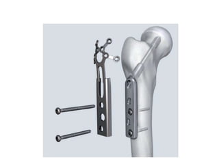Dynamic hip screw with Trochanteric Stabilization plate Case ...