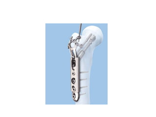 Dynamic hip screw with Trochanteric Stabilization plate Case ...