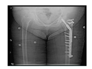 Dynamic hip screw with Trochanteric Stabilization plate Case ...