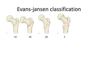 Dynamic hip screw with Trochanteric Stabilization plate Case ...