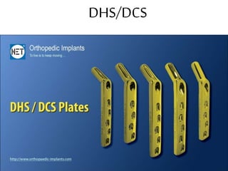 manufacturer-and-suppliers-dhs dcs-blade-plates | PPTX