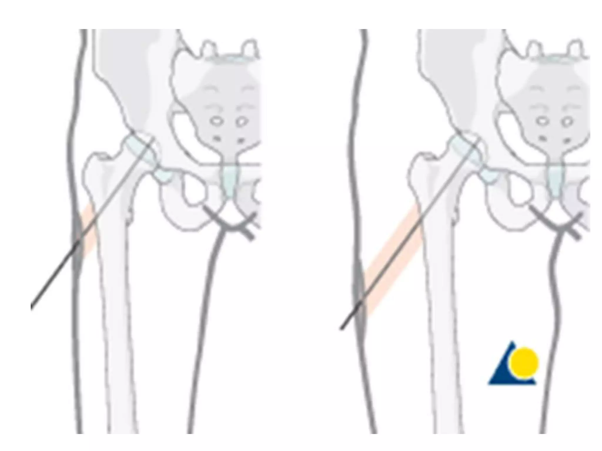 dynamic hip screw | PPTX
