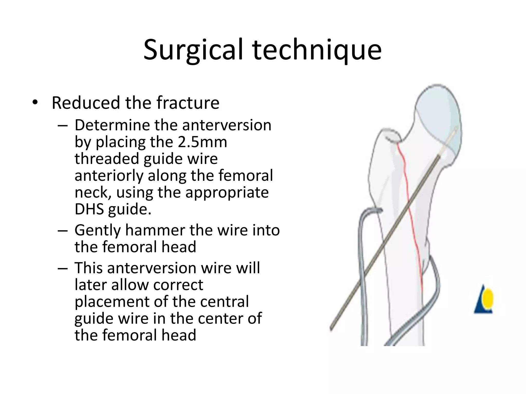 dynamic hip screw | PPTX