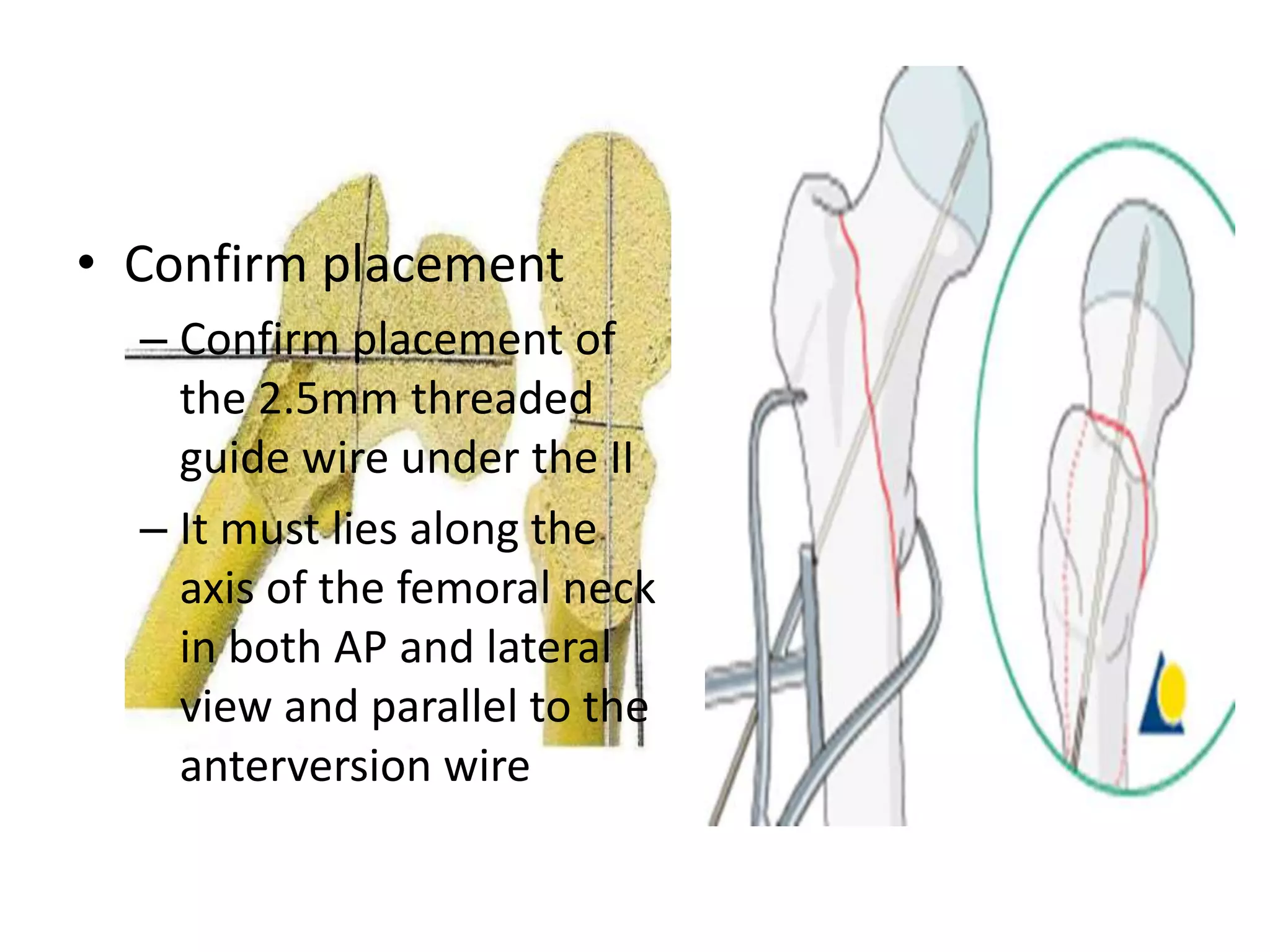 dynamic hip screw | PPTX