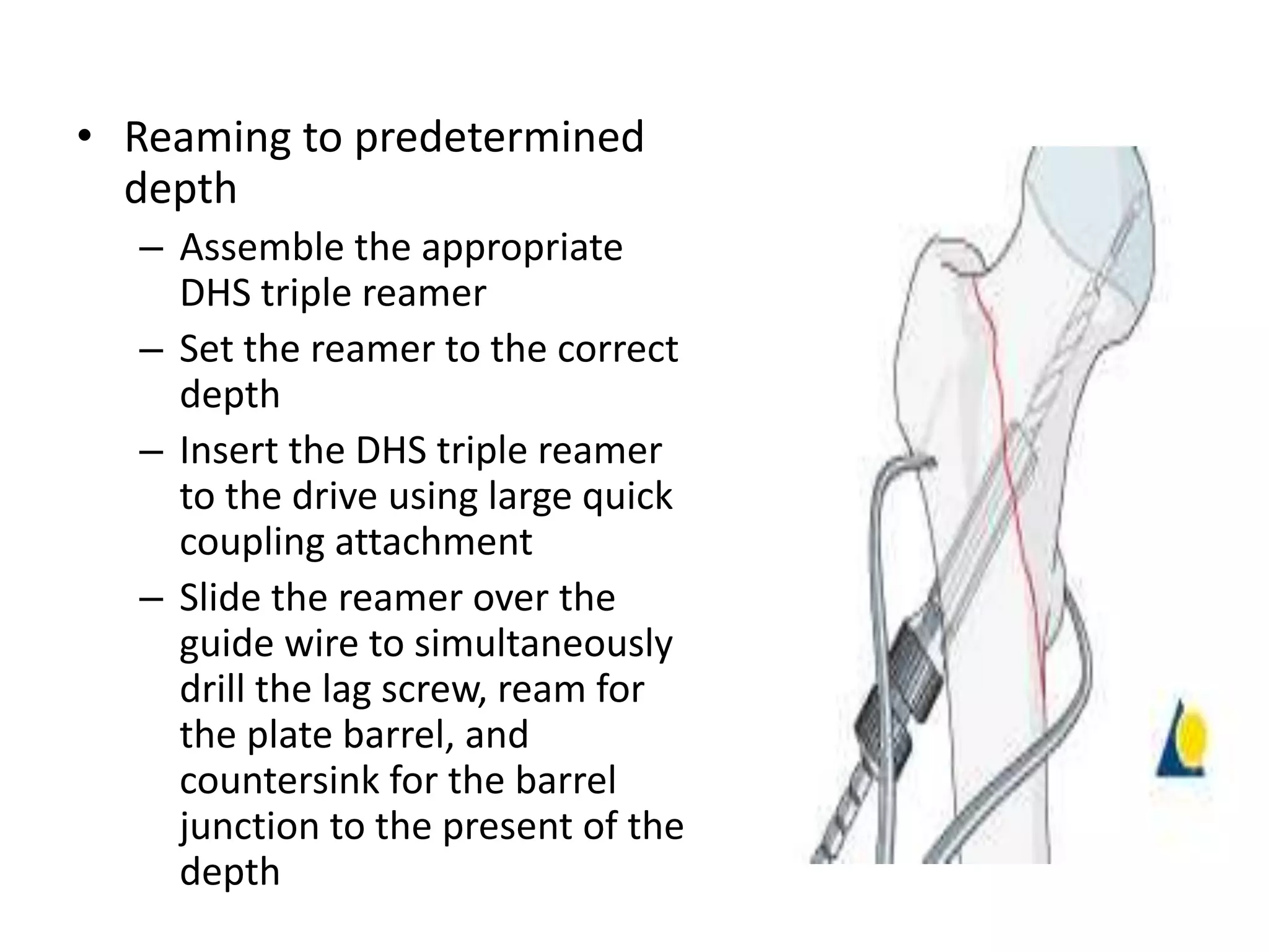 dynamic hip screw | PPTX
