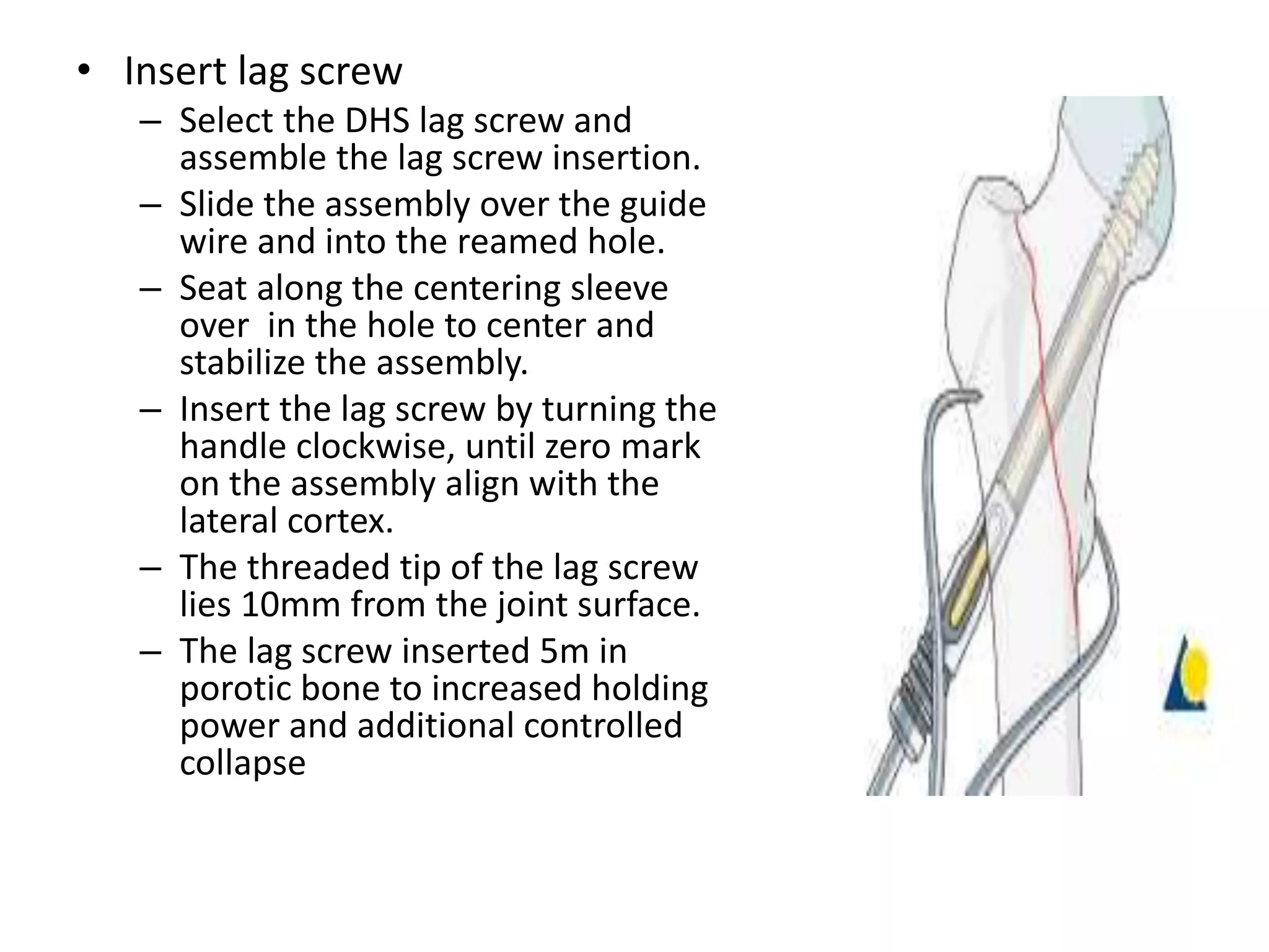 dynamic hip screw | PPTX