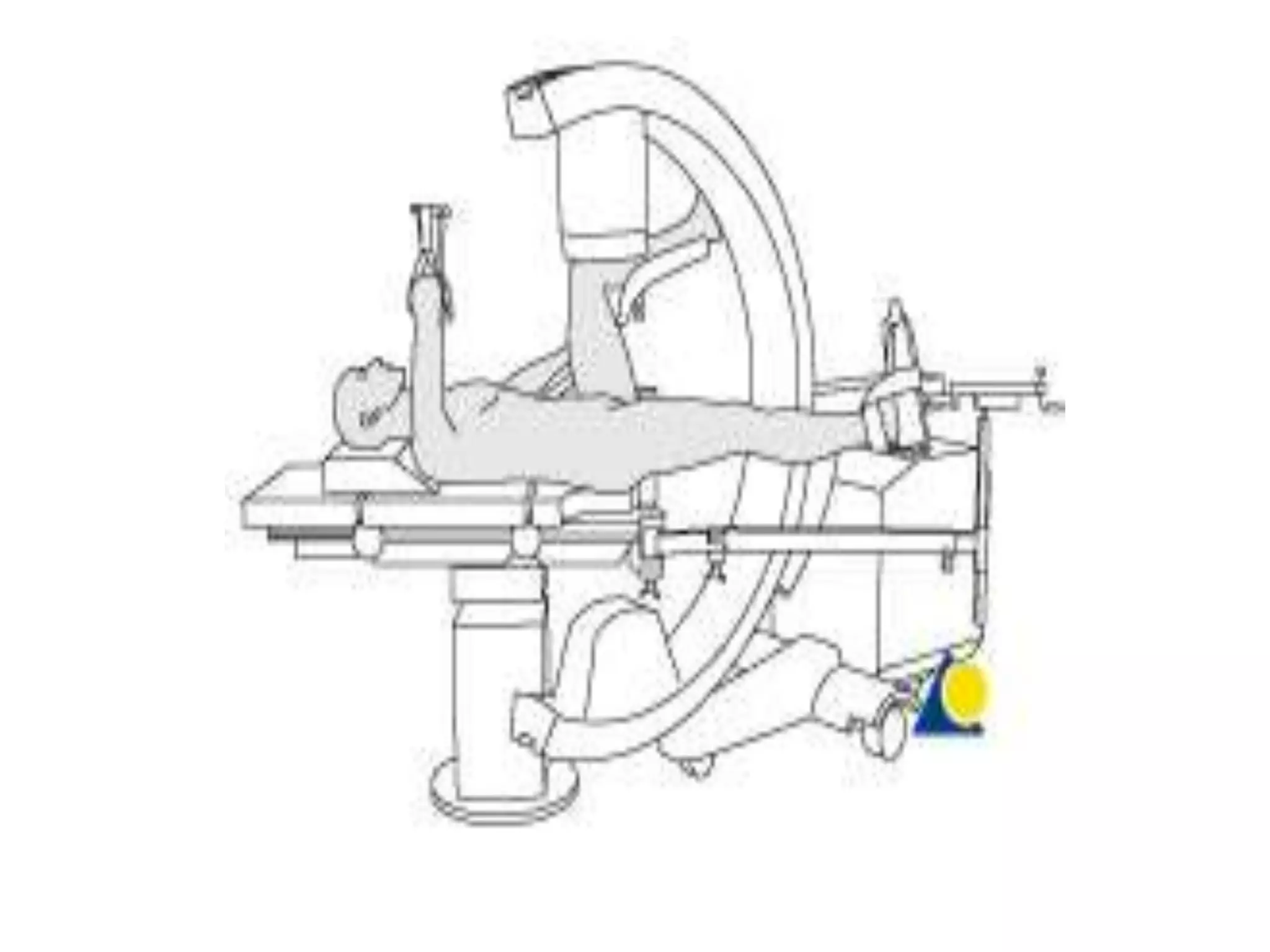 dynamic hip screw | PPTX
