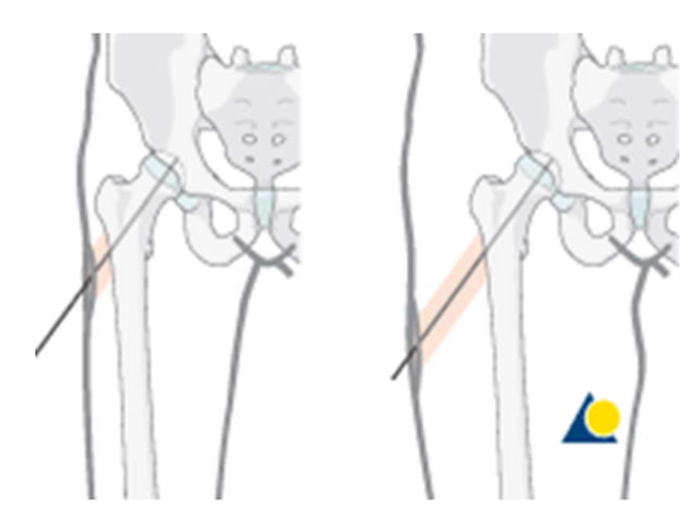 dynamic hip screw | PPTX
