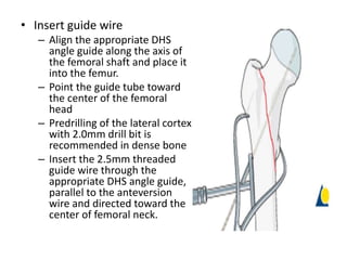 dynamic hip screw | PPTX