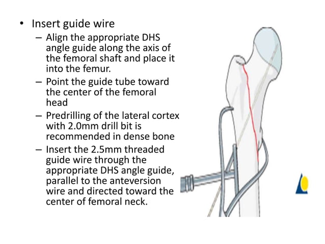 dynamic hip screw | PPTX