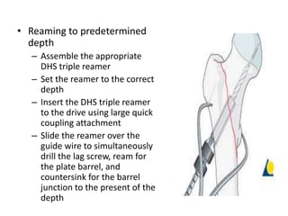 dynamic hip screw | PPTX