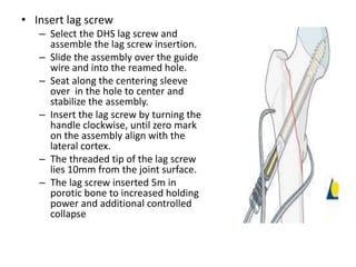 dynamic hip screw | PPTX