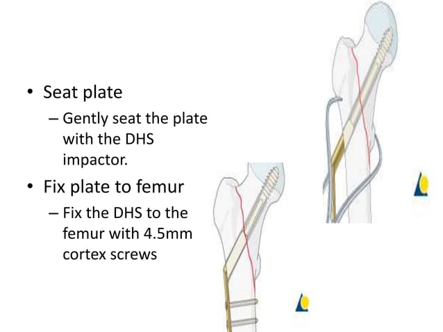 dynamic hip screw | PPTX