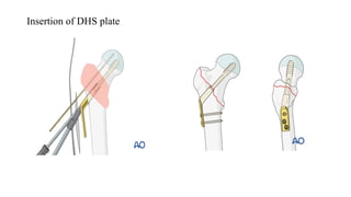 DHS pre-operative plan intertroch fracture.pptx