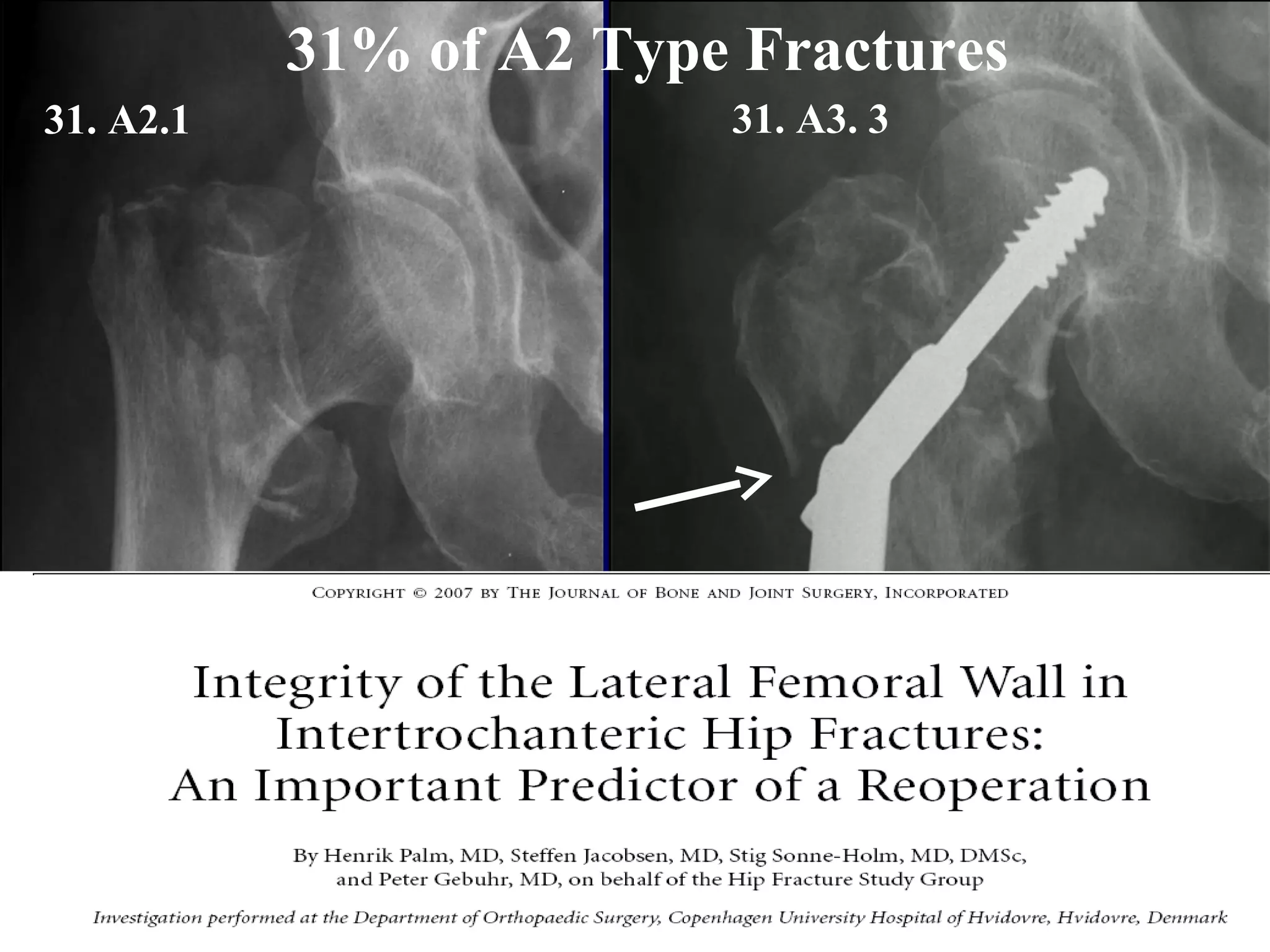 DHS vs PFNA for Intertrochanteric fractures - Dr Chintan N Patel | PPT