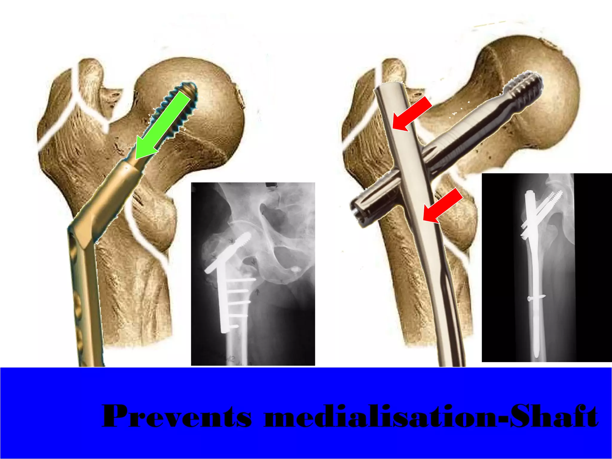 DHS vs PFNA for Intertrochanteric fractures - Dr Chintan N Patel | PPT