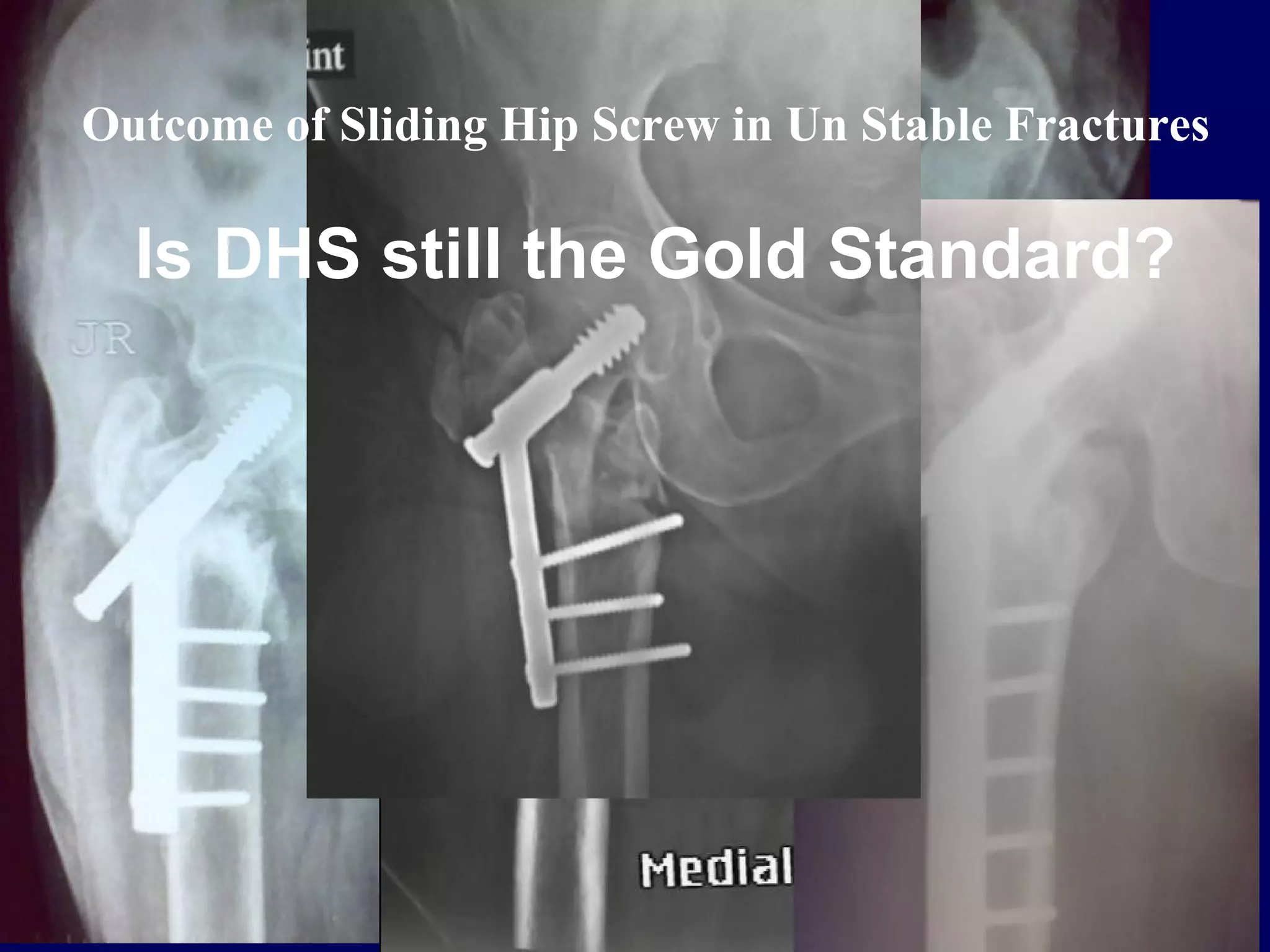 DHS vs PFNA for Intertrochanteric fractures - Dr Chintan N Patel | PPT