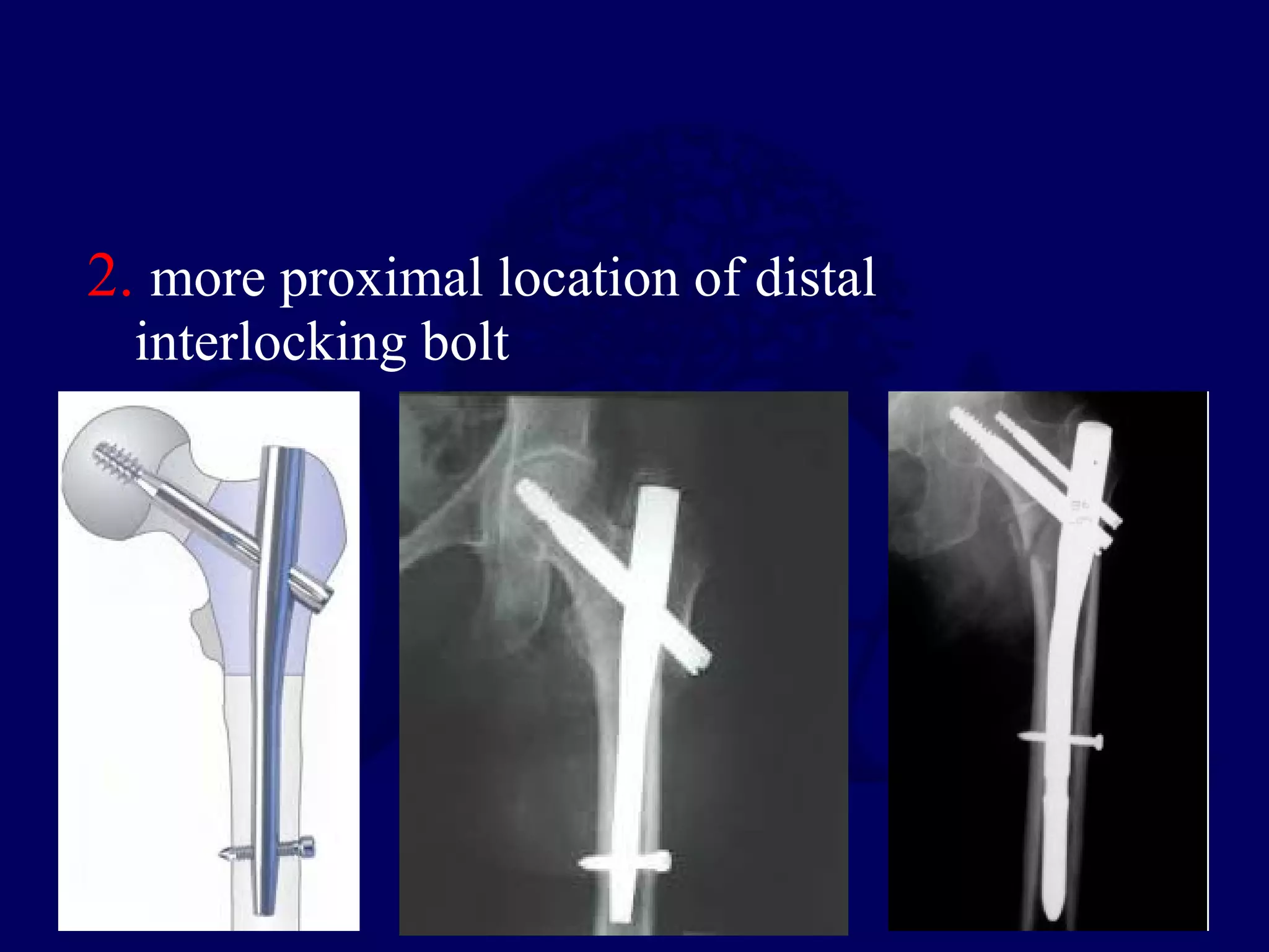 DHS vs PFNA for Intertrochanteric fractures - Dr Chintan N Patel | PPT