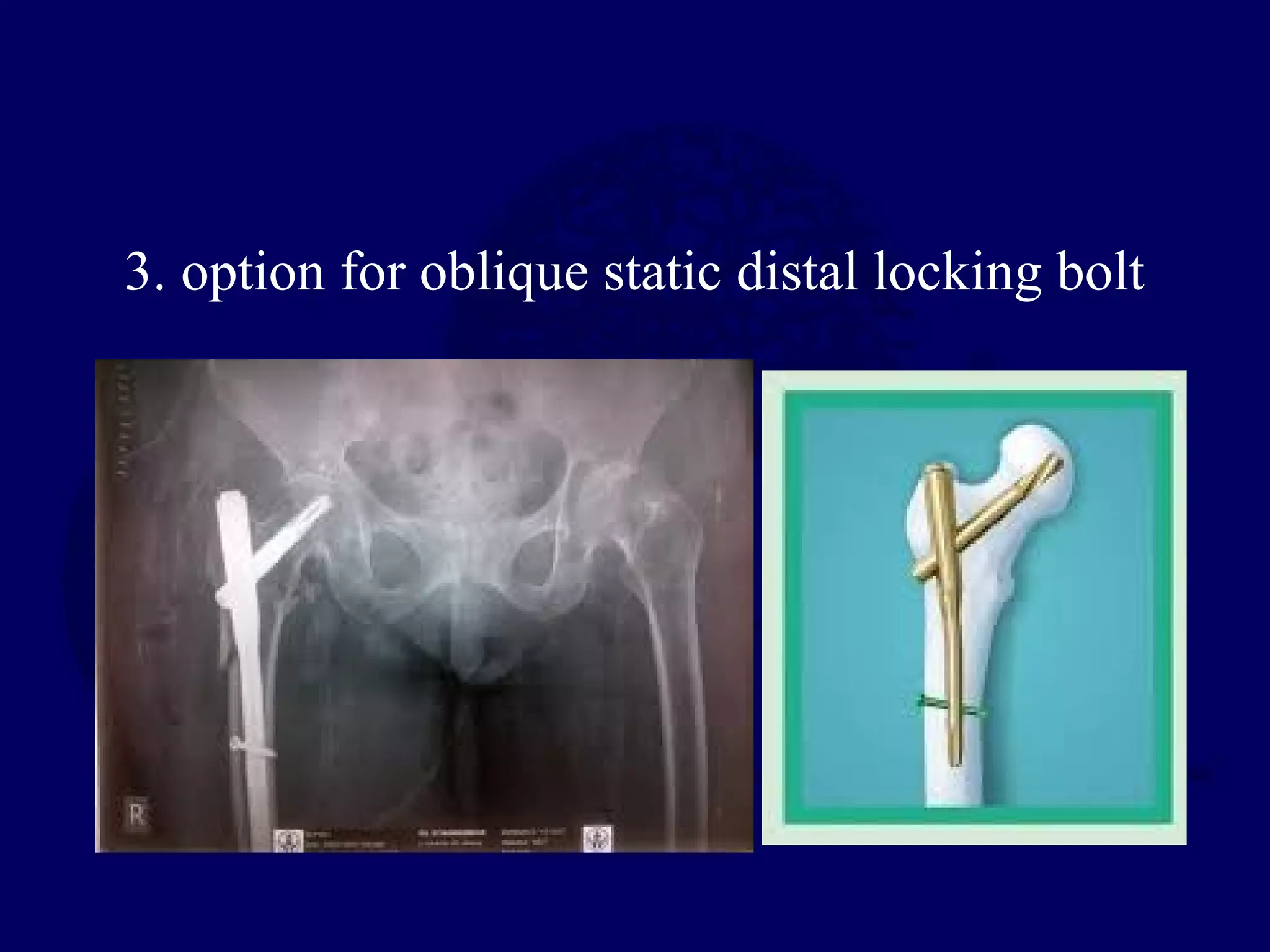 DHS vs PFNA for Intertrochanteric fractures - Dr Chintan N Patel | PPT