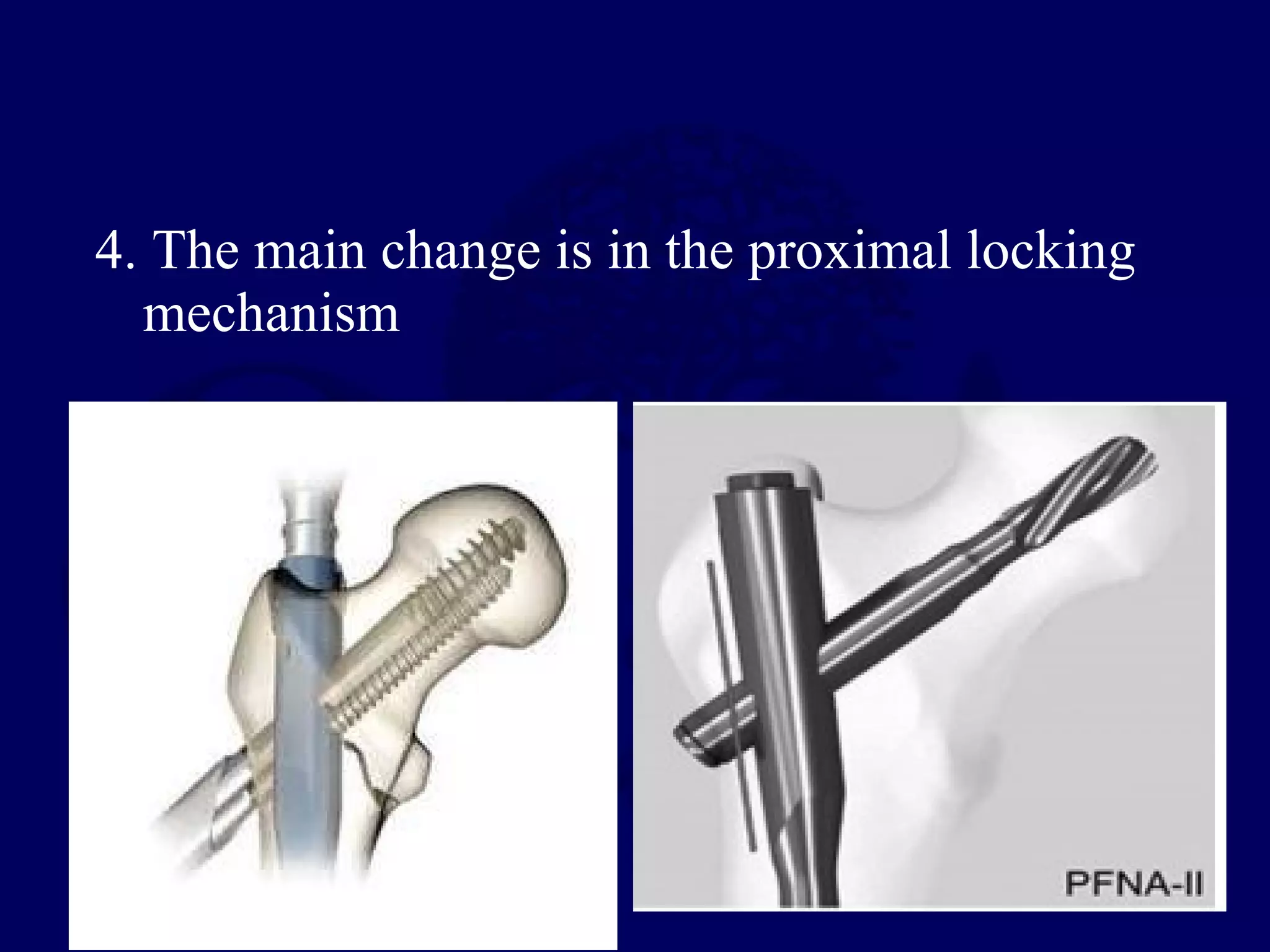 DHS vs PFNA for Intertrochanteric fractures - Dr Chintan N Patel | PPT