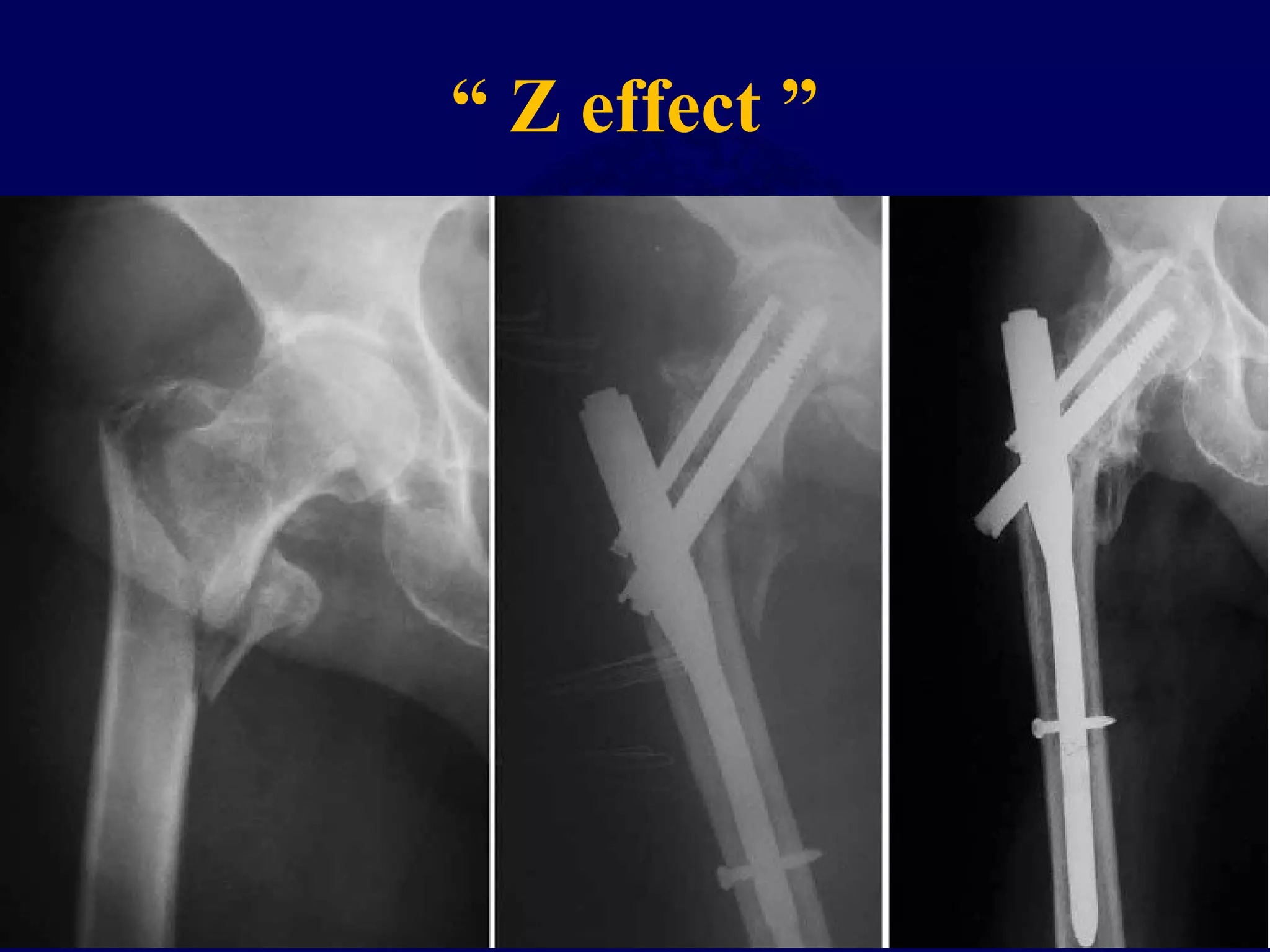 DHS vs PFNA for Intertrochanteric fractures - Dr Chintan N Patel | PPT