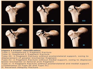 DHS vs PFNA for Intertrochanteric fractures - Dr Chintan N Patel | PPT