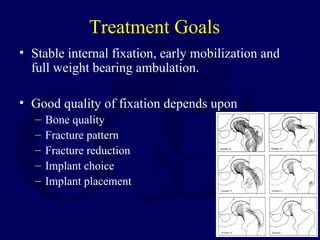 DHS vs PFNA for Intertrochanteric fractures - Dr Chintan N Patel | PPT