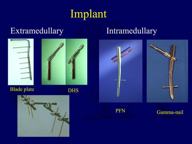 DHS vs PFNA for Intertrochanteric fractures - Dr Chintan N Patel | PPT ...
