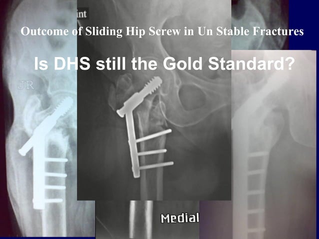 DHS vs PFNA for Intertrochanteric fractures - Dr Chintan N Patel | PPT ...