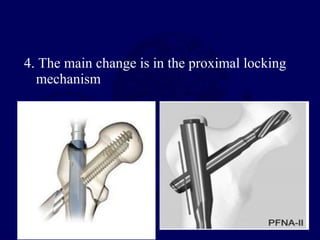 DHS vs PFNA for Intertrochanteric fractures - Dr Chintan N Patel | PPT