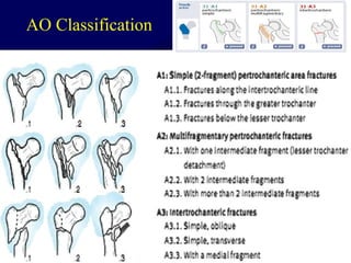 DHS vs PFNA for Intertrochanteric fractures - Dr Chintan N Patel | PPT