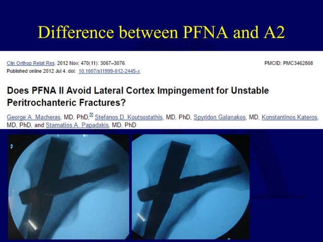 DHS vs PFNA for Intertrochanteric fractures - Dr Chintan N Patel | PPT