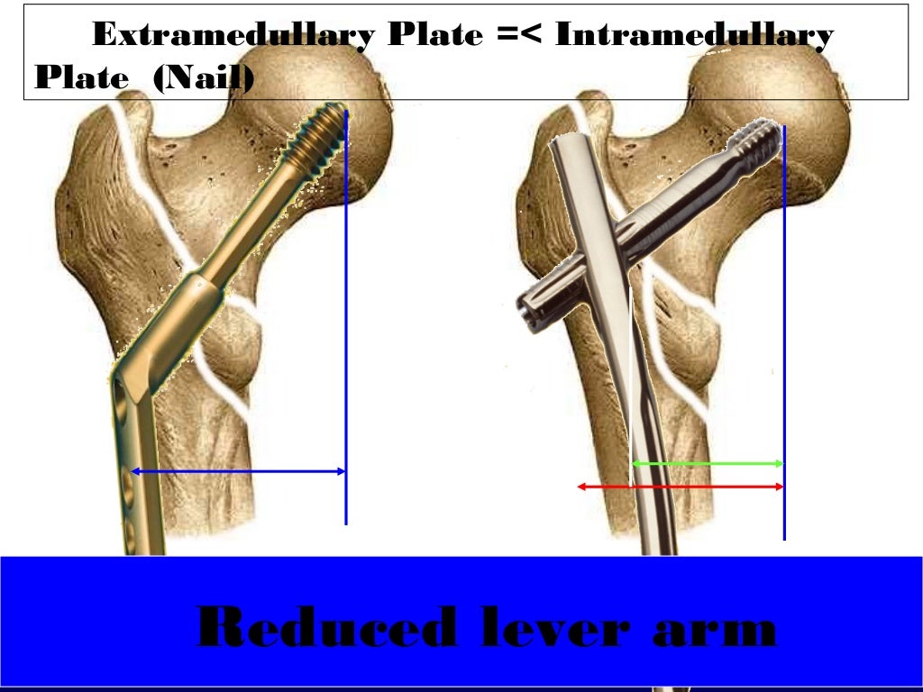 DHS vs PFNA for Intertrochanteric fractures - Dr Chintan N Patel