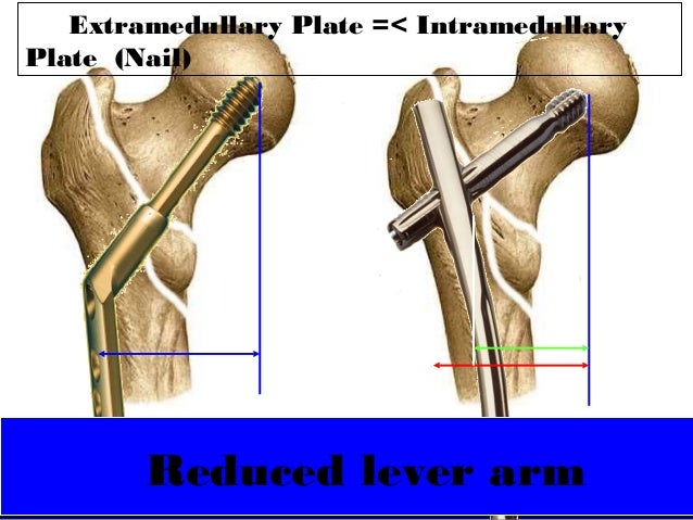 DHS vs PFNA for Intertrochanteric fractures - Dr Chintan N Patel