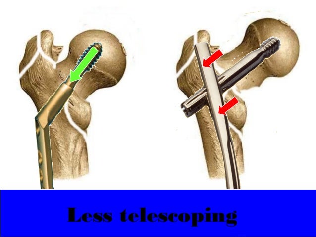 DHS vs PFNA for Intertrochanteric fractures - Dr Chintan N Patel