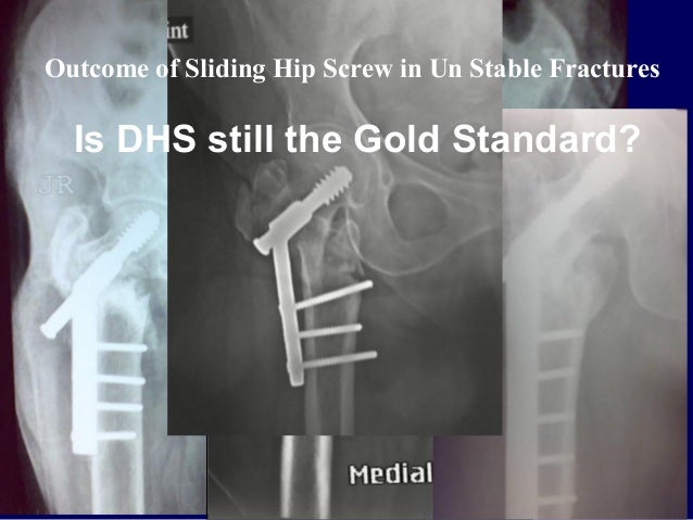 DHS vs PFNA for Intertrochanteric fractures - Dr Chintan N Patel