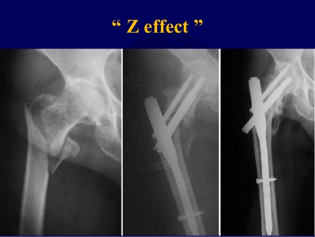 DHS vs PFNA for Intertrochanteric fractures - Dr Chintan N Patel
