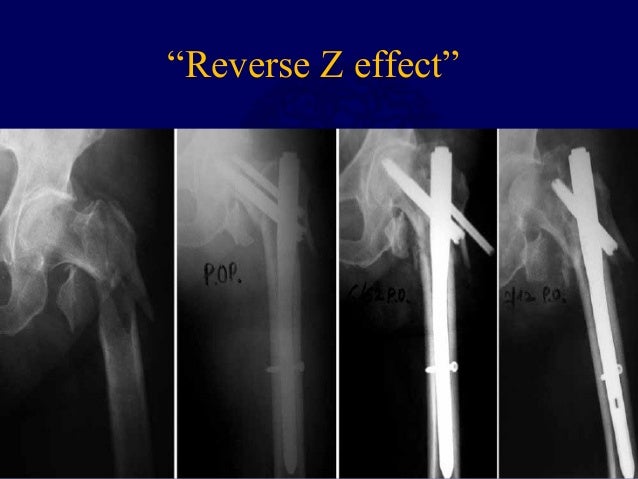 DHS vs PFNA for Intertrochanteric fractures - Dr Chintan N Patel