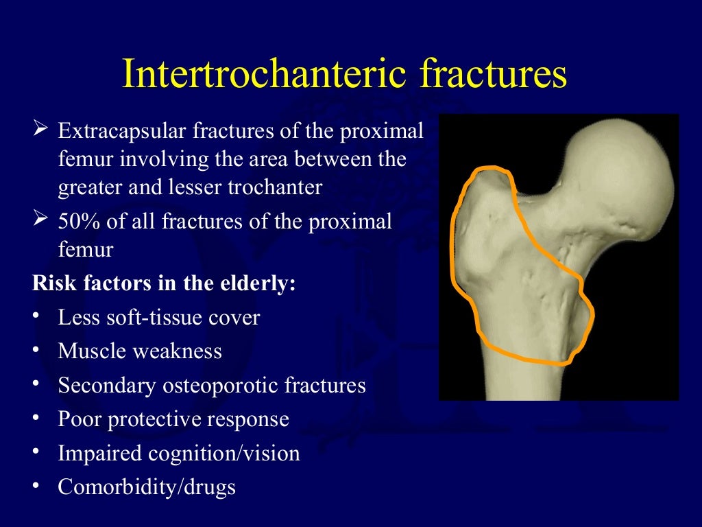 DHS vs PFNA for Intertrochanteric fractures - Dr Chintan N Patel