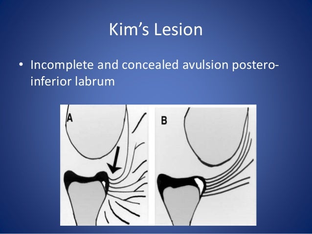 Post instability echte