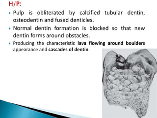 Dentinogenesis Imperfecta | PPTX