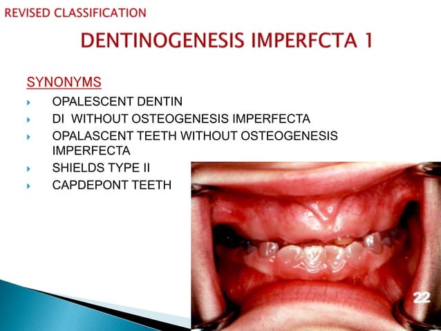 Dentinogenesis Imperfecta | PPTX