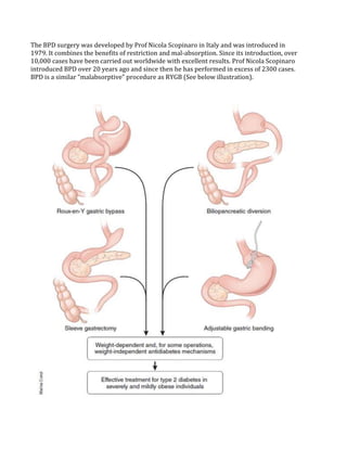 Surgery for treatment of Diabetes | PDF