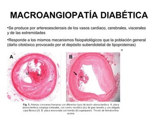 Diabetes: ANATOMIA PATOLÓGICA DE NEUROPATIA, MICROANGIOPATIA, DIABETES ...