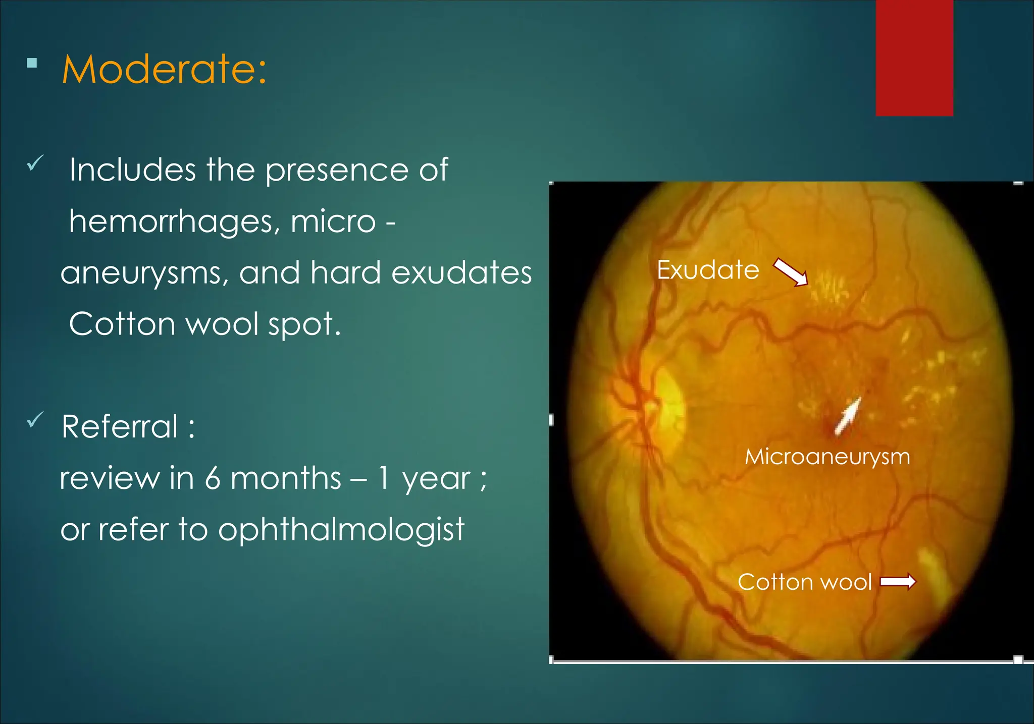 Occular involvement in diabetes mellitus.ppt