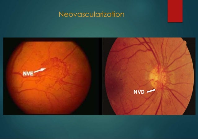 DIABETES AND THE EYE